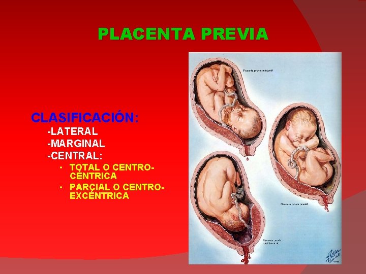 TEMA OBSTETRICIA23 HEMORRAGIAS DE LA SEGUNDA MITAD DEL