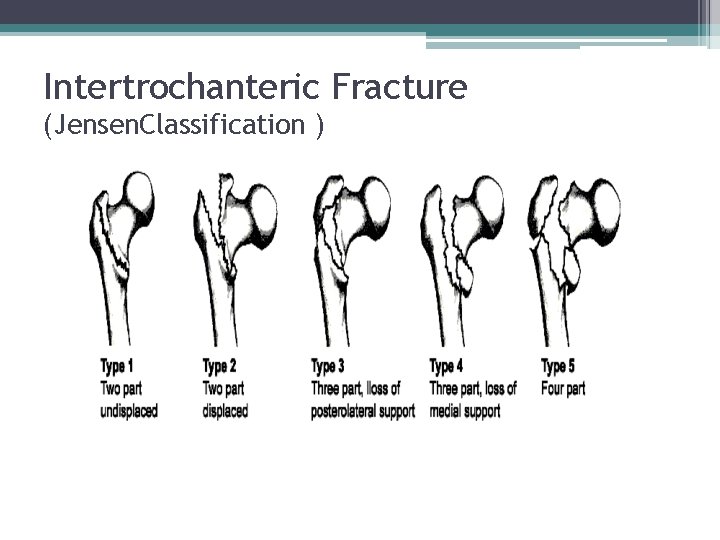 HIP FRACTURES Dr Deepa Abichandani Overview Incidence is