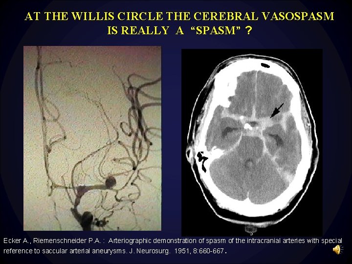 Cerebral Vasospasm post Subarachnoid Hemorrhage Pathophysiological bases for