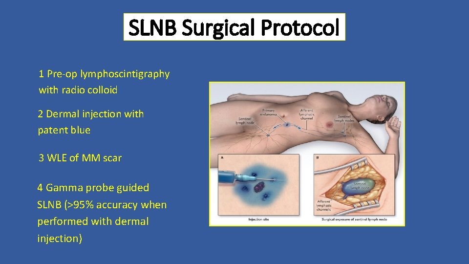20172018 Sentinel Lymph Node Biopsy in Malignant Melanoma