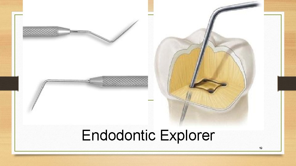 Endodontics AKA Root Canal Therapy RCT 1 Describe