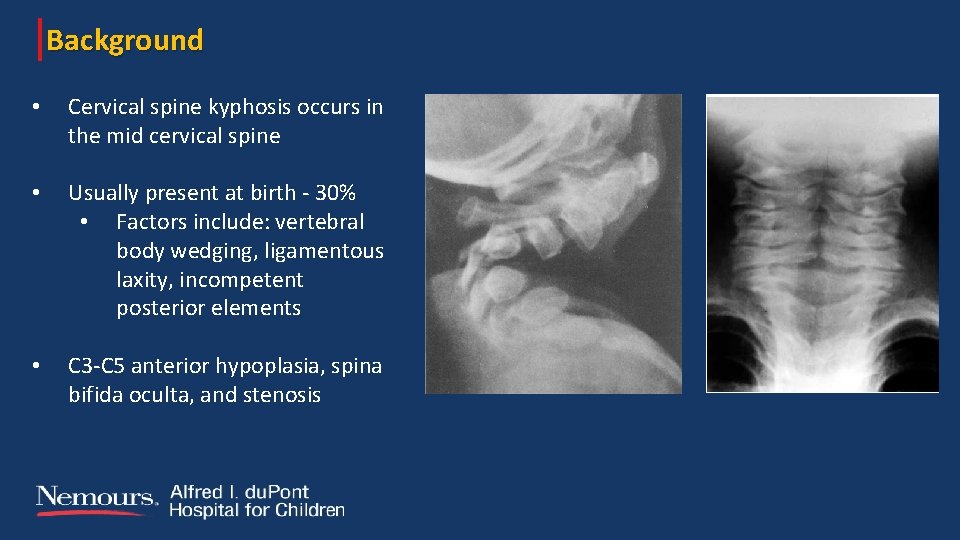 Anterior Vertebrectomy and Cervical Fusion A Technique For