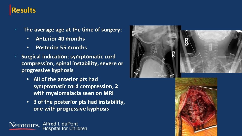 Anterior Vertebrectomy and Cervical Fusion A Technique For