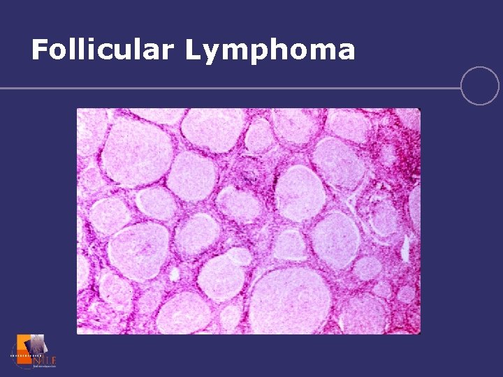 Goals Understand the differences between Hodgkin Lymphoma and