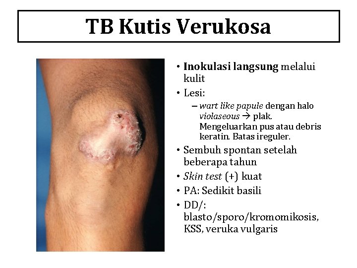 TATALAKSANA TUBERKULOSIS KUTIS Dr Erdina HD Pusponegoro Sp