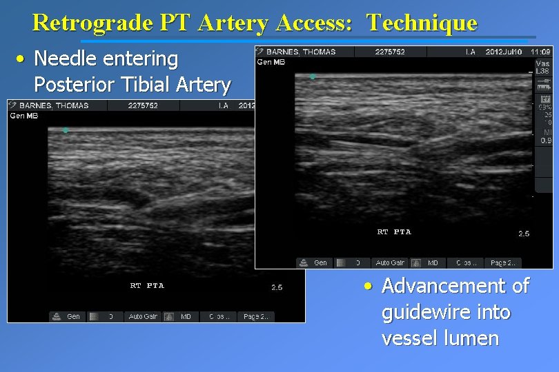 Peripheral Arterial Disease Critical Limb Ischemia Pedal Approach