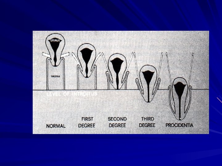 PELVIC ORGAN PROLAPS Risk Factors Pregnancy Vaginal childbirth
