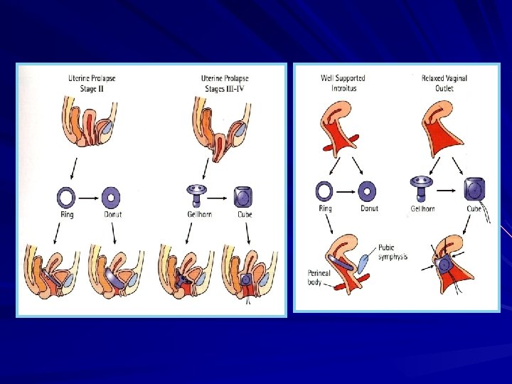 PELVIC ORGAN PROLAPS Risk Factors Pregnancy Vaginal childbirth