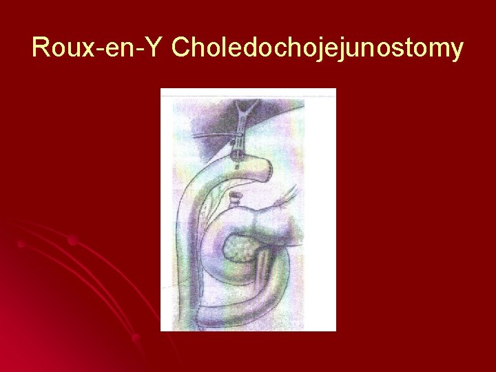 Extrahepatic Biliary and Vascular Injuries Niqui Kiffin MD