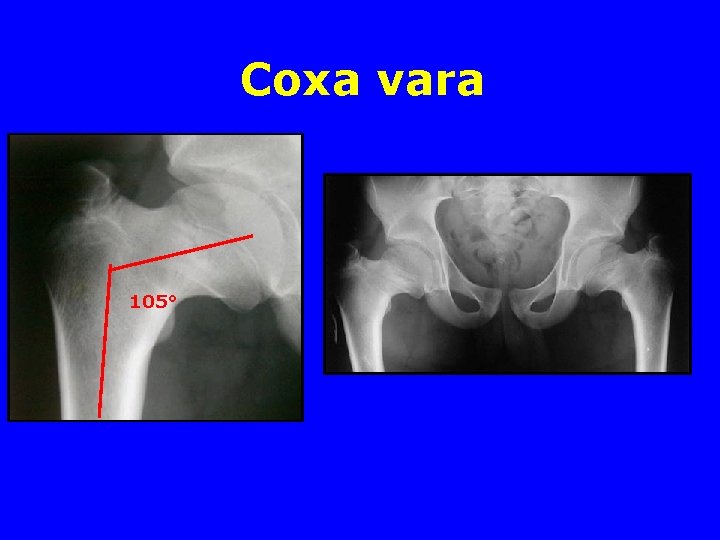 Cadera Normal Coxa Valga y displasia del acetbulo