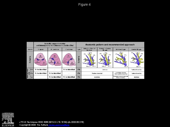Right Upper Lobe Segmentectomy Guided By Simplified Anatomic