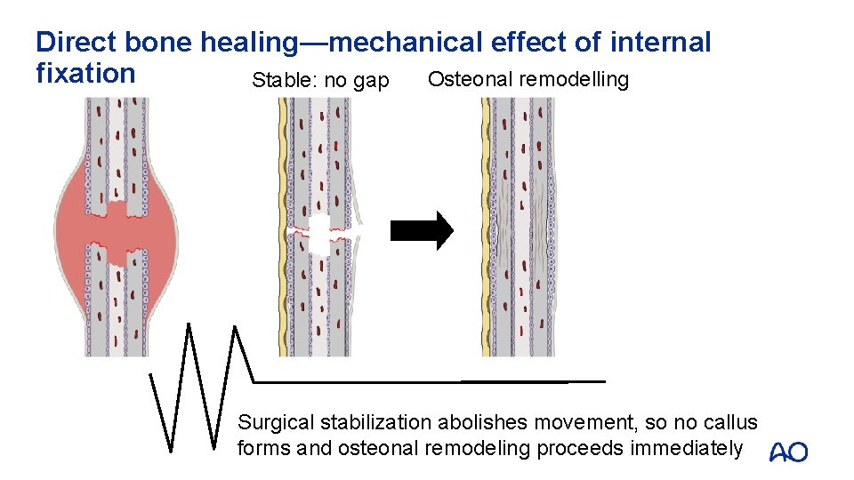 Biology of bone healing AO Trauma Basic Principles
