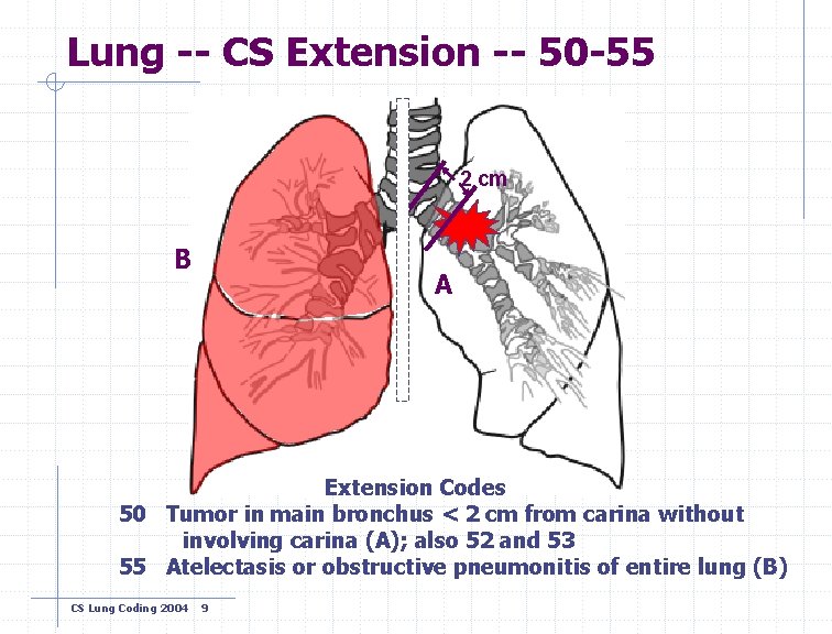 The Anatomy of Collaborative Staging Lung Presentation developed