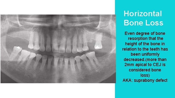 Periodontal Disease Horizontal And Vertical Bone Loss Localized