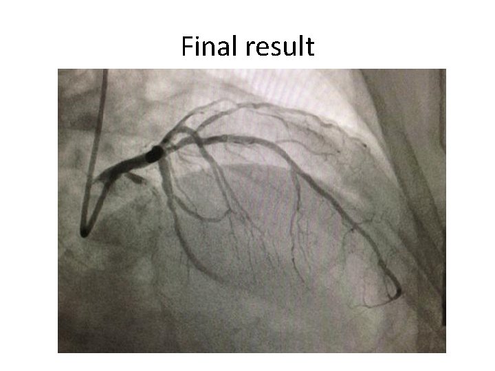 Use Of The Novel Orbital Atherectomy System For