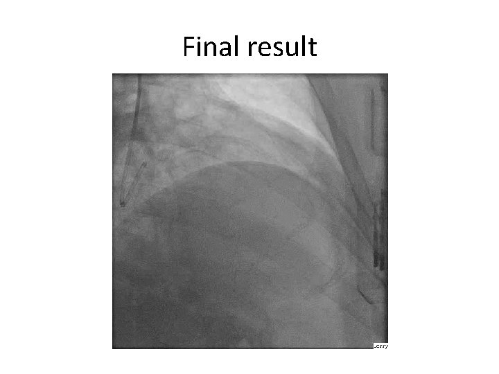 Use Of The Novel Orbital Atherectomy System For