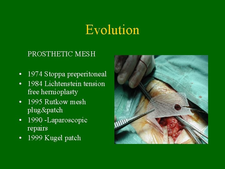 HOW SHOULD INGUINAL HERNIAS BE REPAIRED IN 2001