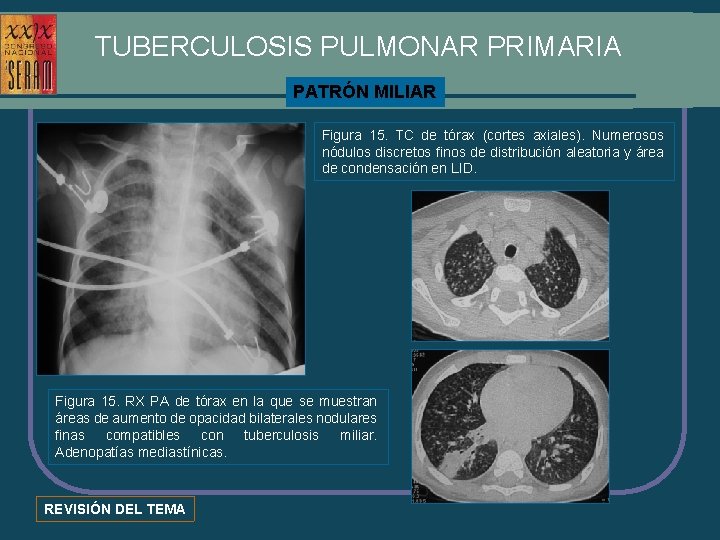TUBERCULOSIS PULMONAR PRIMARIA PATRN MILIAR l l l