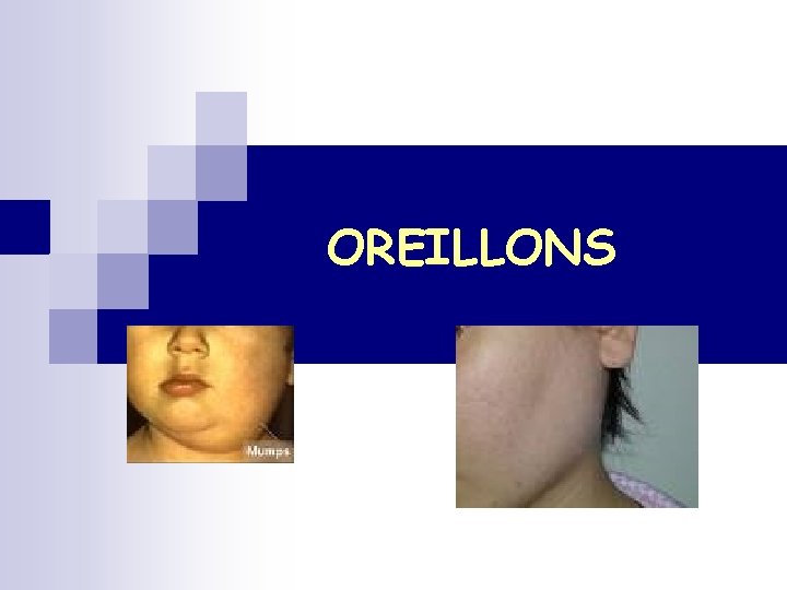 RUBEOLE OREILLONS VARICELLE L MARCUS Fvrier 2009 RUBEOLE