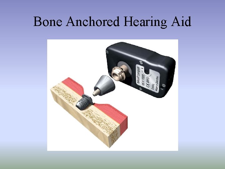 Bone Anchored Hearing Aid or Cochlea Implant Timothy