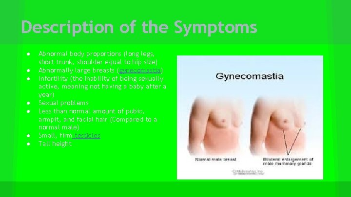Klinefelter Syndrome By Abanoub Narouz and Omar Definition