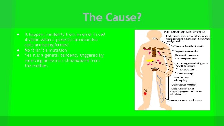 Klinefelter Syndrome By Abanoub Narouz and Omar Definition