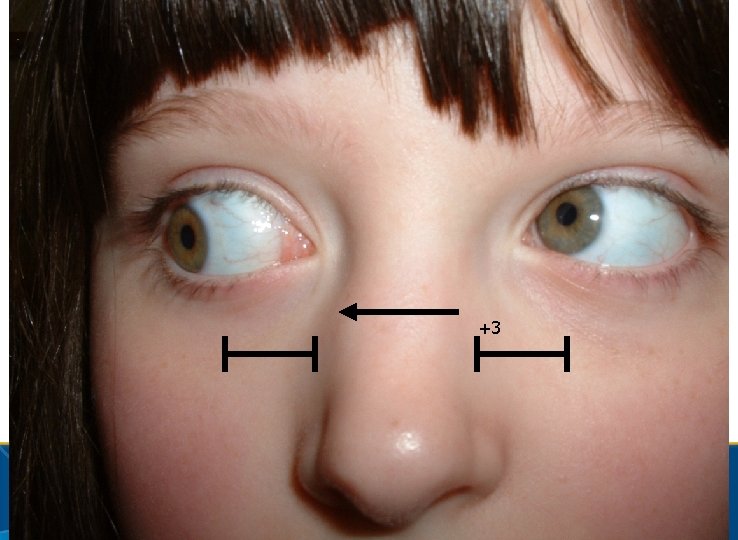 Vertical Strabismus A and V Patterns Matthew D