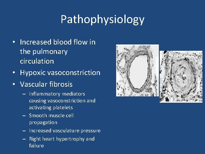 Pulmonary Hypertension and Various Treatment Options Presented by
