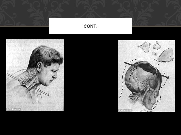JFK AUTOPSY BY ABBY HUNT MARISSA THOMSEN ROSALIE
