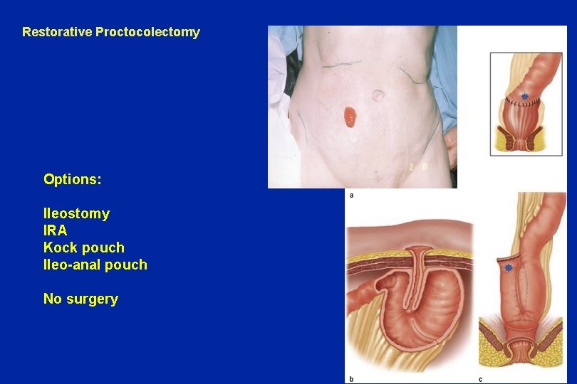 Restorative Proctocolectomy Kangaroo Club Information Day Bruce George