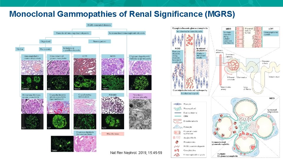 MANAGEMENT AND TREATMENT OF GLOMERULAR DISEASES MEMBRANOPROLIFERATIVE GLOMERULONEPHRITIS