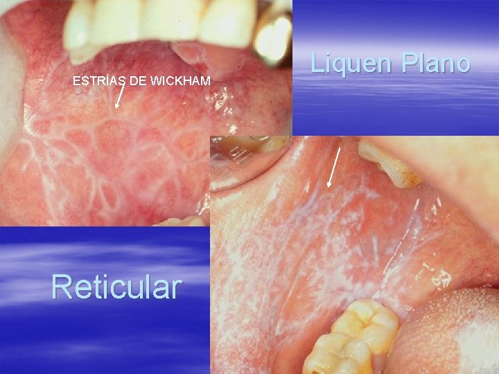 Lesiones potencialmente cancerizables de la mucosa bucal Dra