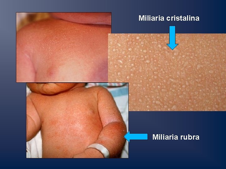DERMATOSIS NEONATALES Dra Susana Habermacher CATEDRA DE DERMATOLOGIA