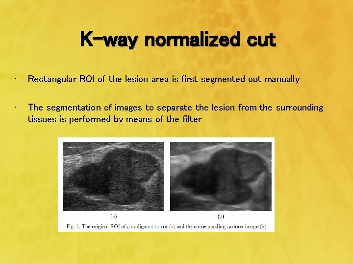 Measuring shape complexity of breast lesions on ultrasound