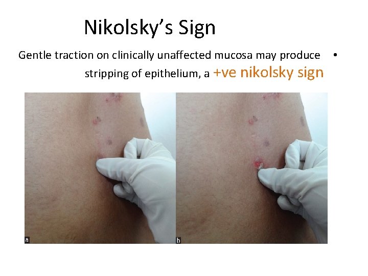 Vesiculobullous diseases A vesiculobullous disease is a type