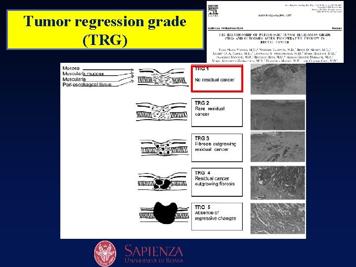 VINCENZO TOMBOLINI CATTEDRA DI RADIOTERAPIA Universit Sapienza di