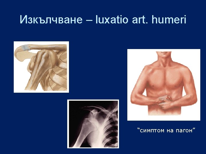 Regio deltoidea n Regio brachialis anterior et posterior