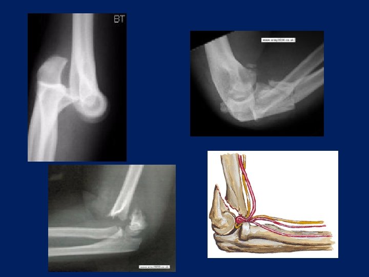 Regio deltoidea n Regio brachialis anterior et posterior
