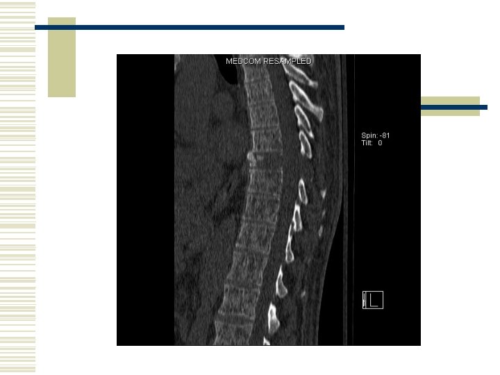 RED FLAGS CAUDA EQUINA Stuart Fraser Physiotherapist Wessex