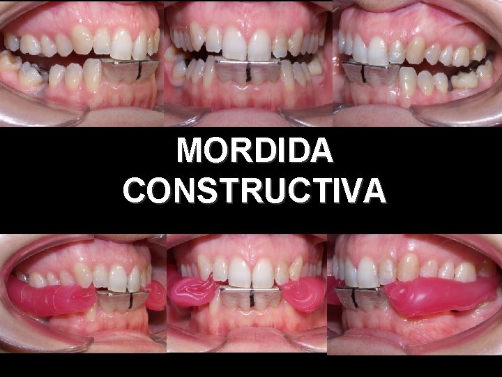 METODO DE REGISTRO DE LA MORDIDA CONSTRUCTIVA PARA