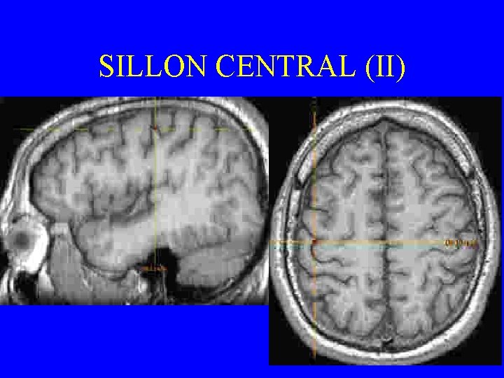 RADIOANATOMIE DU CORTEX CEREBRAL Marc Braun 2008 Neuroradiologie