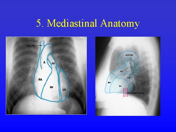 Reading the CXR Frank Schembri Pulmonary Critical Care