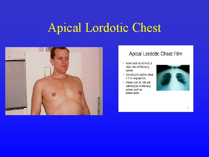 Reading the CXR Frank Schembri Pulmonary Critical Care