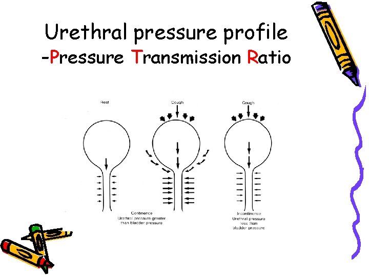 Urinary incontinence Urinary incontinence is a condition in