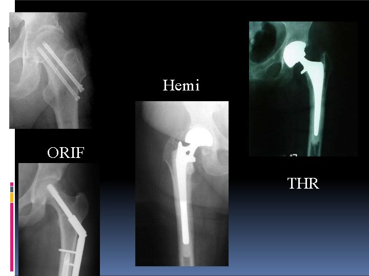 Lower Extremity Trauma Hip Fractures Dislocations Femur Fractures