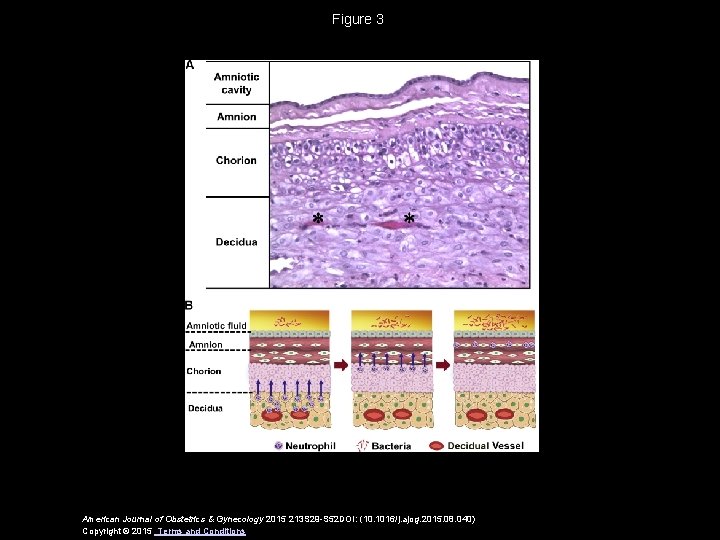 Acute chorioamnionitis and funisitis definition pathologic features and