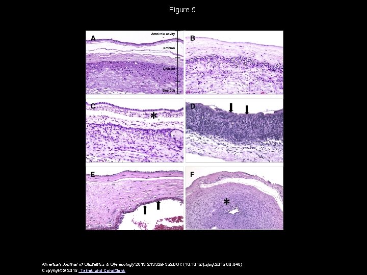 Acute chorioamnionitis and funisitis definition pathologic features and