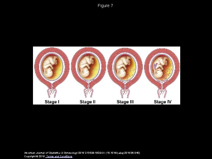 Acute chorioamnionitis and funisitis definition pathologic features and