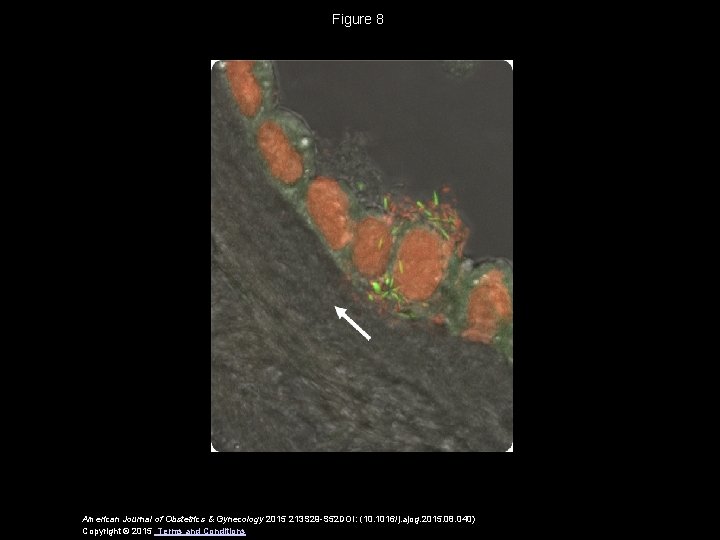 Acute chorioamnionitis and funisitis definition pathologic features and