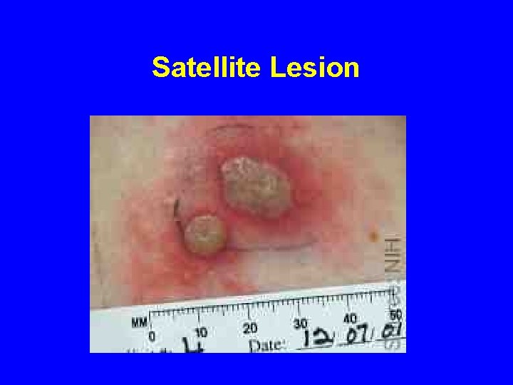 Smallpox Vaccinee Evaluation and FollowUp WVDHHRBPH US Department